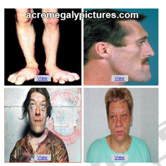 Abnormal Growths – Human growth, development and nutrition