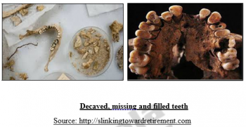 Importance of Dental Records in Forensic Odontology – Forensic anthropology